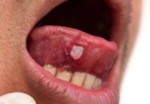 Gamot sa singaw sa dila na ointment - Gamot sa Ngipin