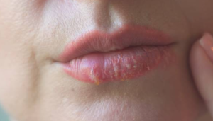 Gamot sa mga Butlig sa Labi at Sintomas - Gamot sa Ngipin