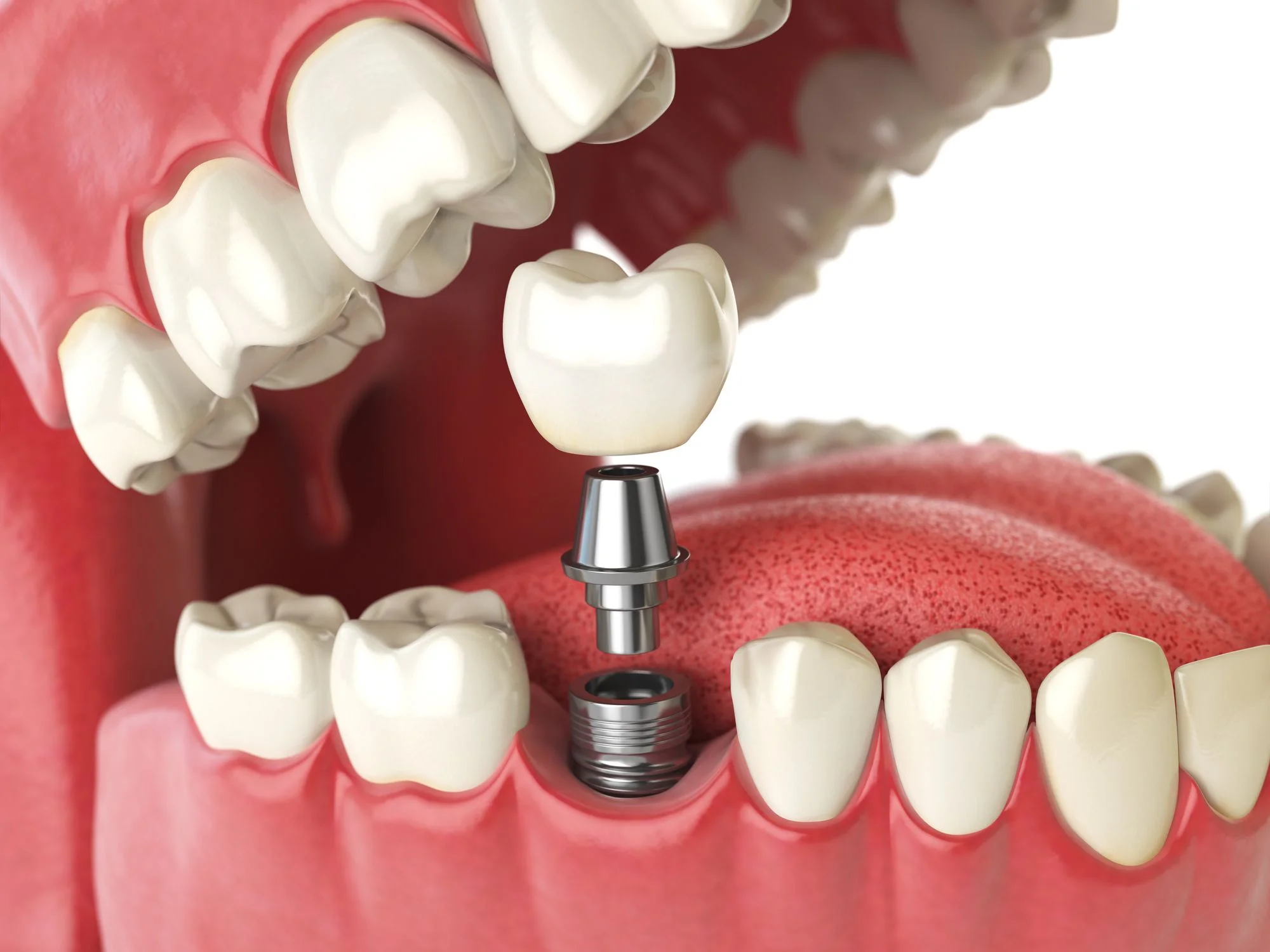 Magkano ang dental implant sa Pilipinas? - Gamot sa Ngipin